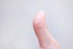 Blister On Thumb From Golf (Remedies, Prevention)